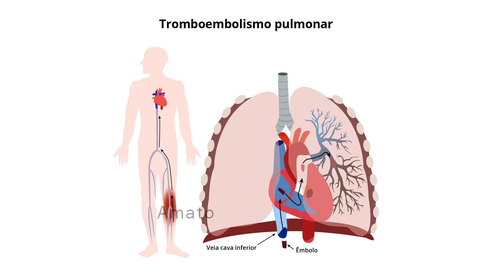 desprende e bloqueia uma artéria pulmonar, impedindo a troca de ...