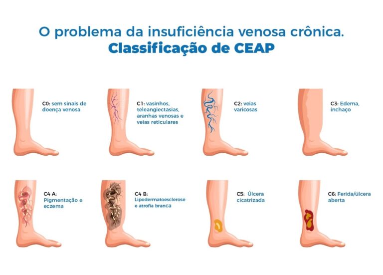 Classificação de CEAP: Como classificar a doença venosa