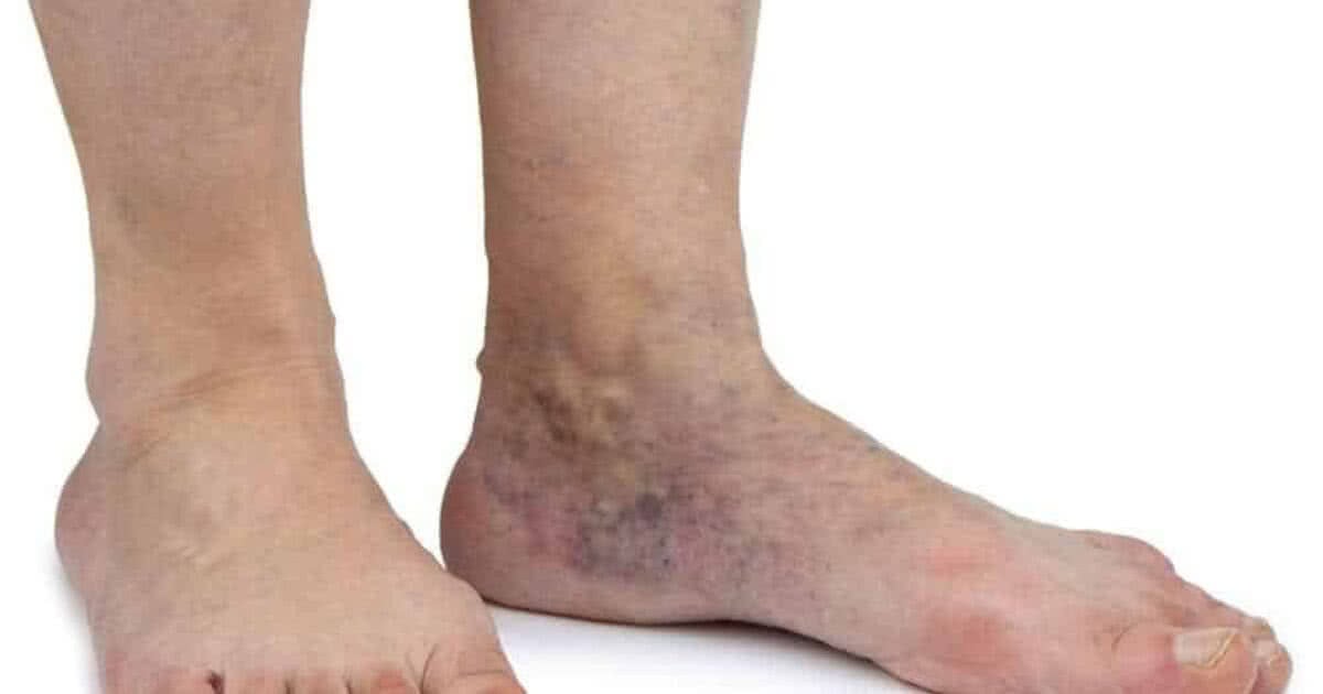 Causas da doença venosa: fatores de risco e prevenção