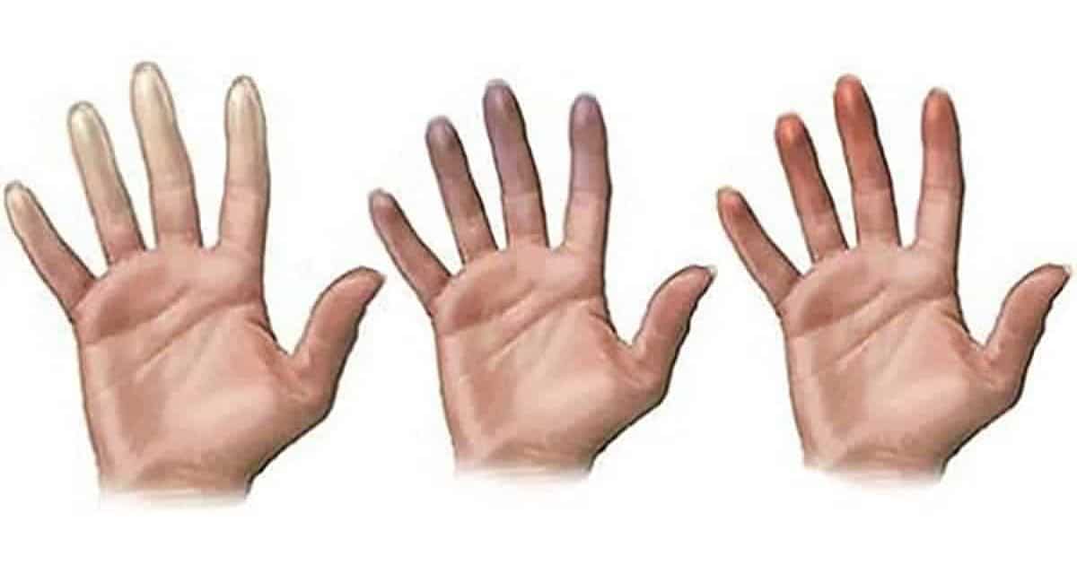 Fenômeno De Raynaud O Que é Causas Sintomas E Tratamento