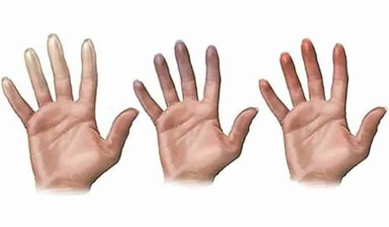 Fenômeno de Raynaud: o que é, causas, sintomas e tratamento