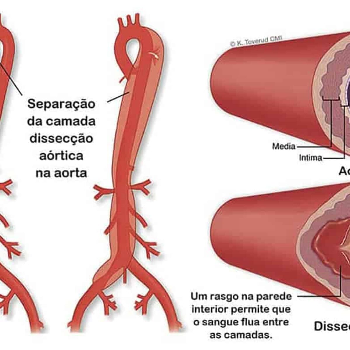 Anatomia Da Aorta Toracica Aneurismi Dell'aorta Toracica | MultiMedica