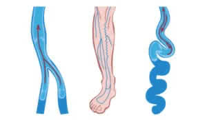 Varizes e Veias Varicosas. Entenda o que são e melhor tratamento.