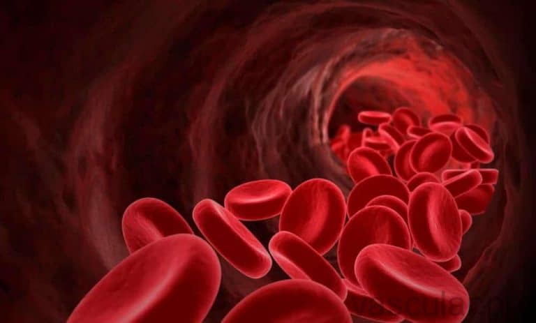 Trombectomia: saiba como é feita a retirada do trombo