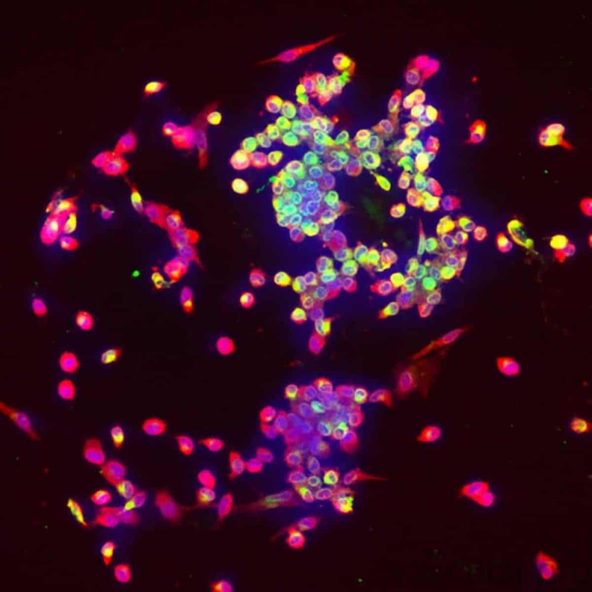 Vasculite: o que é, causas, sintomas e tratamento