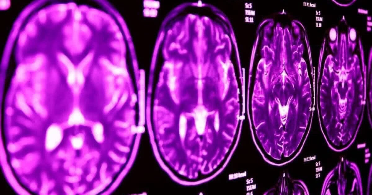 Entenda como acontece o AVC e saiba como prevenir