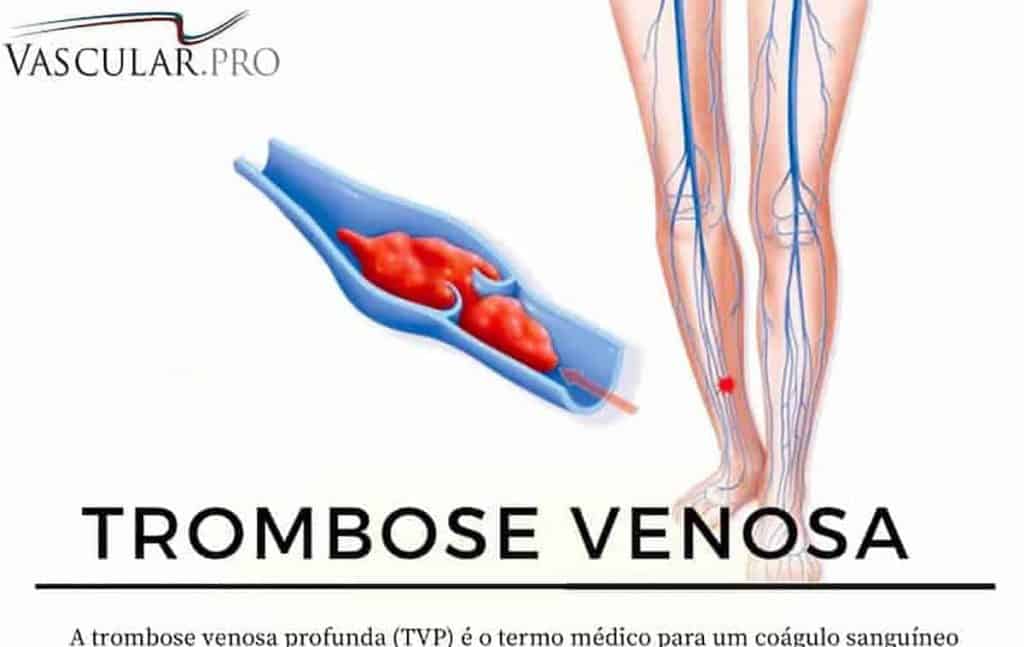 Trombose Venosa - Vascular.pro