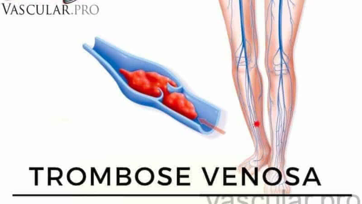 Trombose Arterial Vs Trombose Venosa Figura 55.1