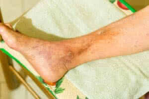 Flebite: o que é, sintomas, tratamentos e riscos para a saúde