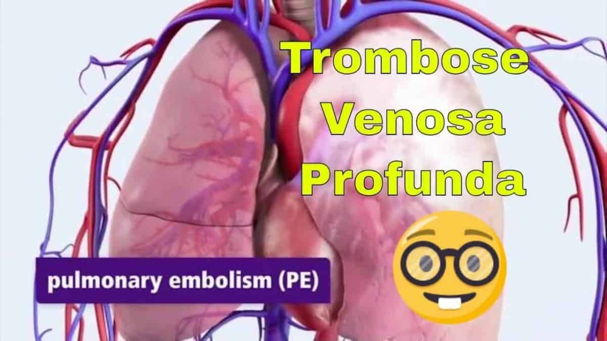 Trombose Venosa Profunda (TVP): causas, sintomas e tratamentos