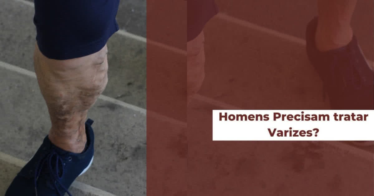 Varizes normalmente não são uma preocupação para os homens, e isso tem ...