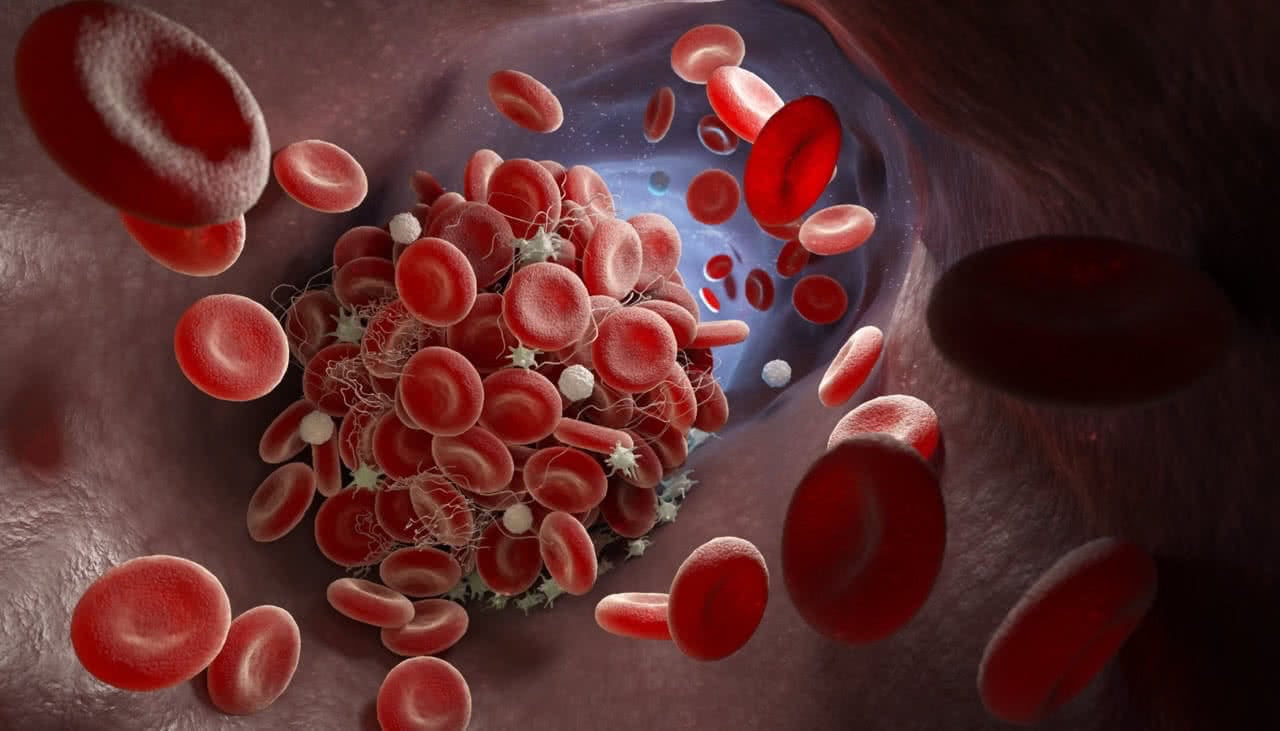 Trombose venosa profunda: conheça os riscos e como prevenir!