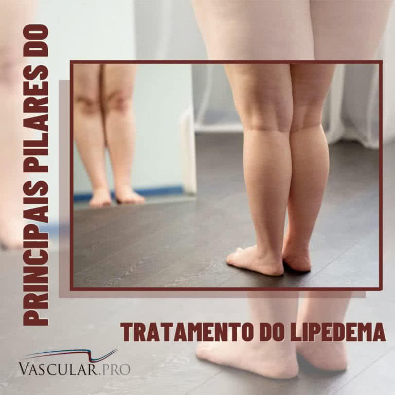 O tratamento do lipedema deve ser individualizado e pensado de acordo ...