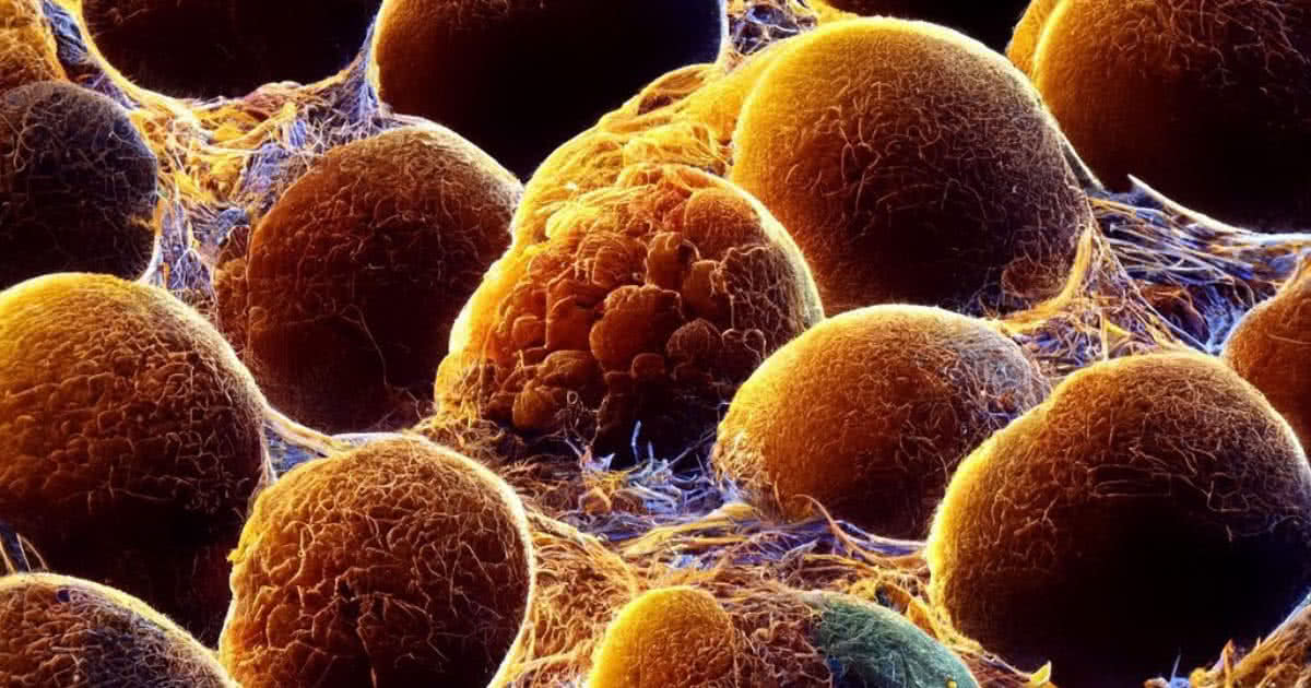 #lipedema células inflamadas - Vascular.pro