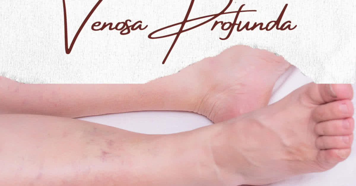 A perna está inchada, dolorida, endurecida, quente e o pé um pouco ...