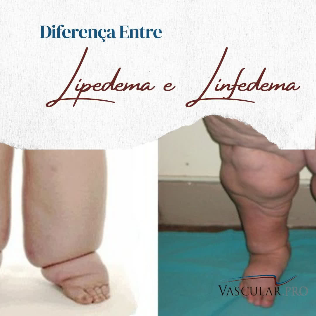 Apesar de semelhantes no nome, o lipedema e linfedema são afecções ...