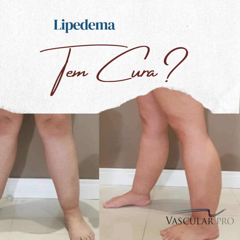 O lipedema, infelizmente, não tem cura. Porém é possível realizar o ...