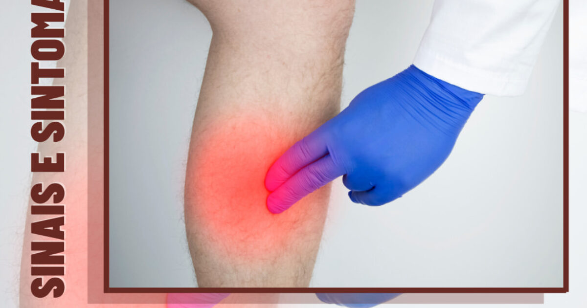 Os sinais e sintomas de um coágulo sanguíneo na perna, ou trombose ...