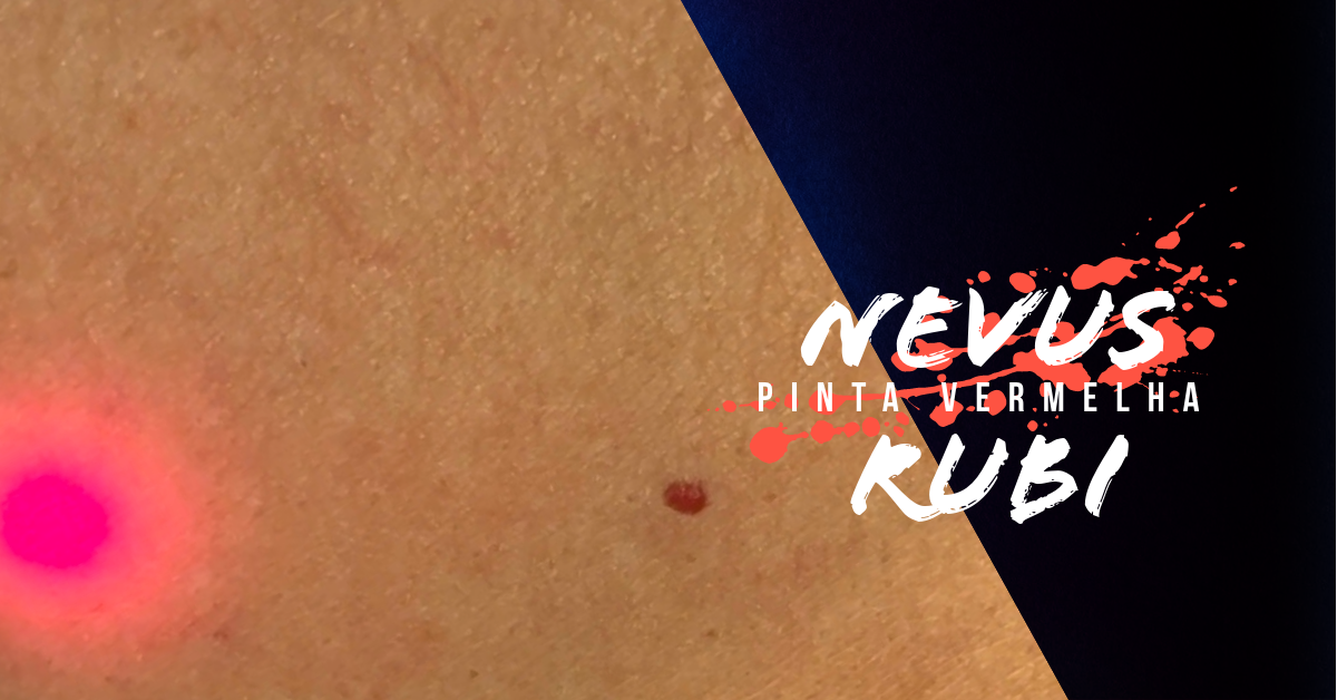 Angioma Rubi (nevus rubi, pinta vermelha, bolinha vermelha): O que Você ...
